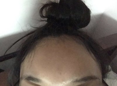 Is there surgery for my odd, sloped and long forehead? (Photos) Doctor ...