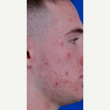 Accutane Side Effects Babies