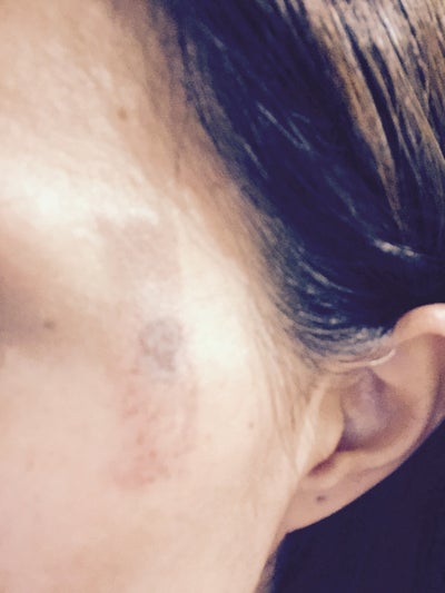 Are these marks normal after IPL (crusting that should peel off) or are ...