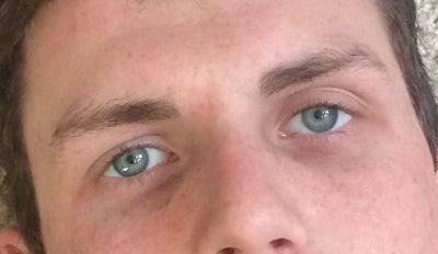 One Eyelid Bigger Than Other Answers On Healthtap