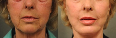 Dermabrasion Before & After Pictures - RealSelf