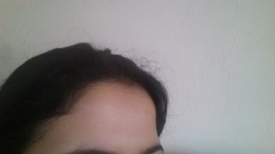 Frontal bossing. How should I go about this? (Photo) Doctor Answers, Tips