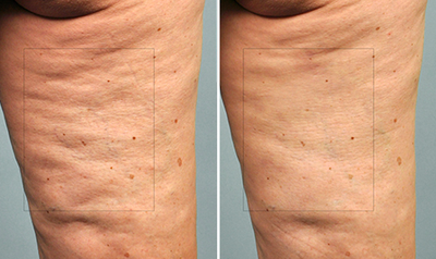 Cellulaze Before & After Pictures - RealSelf