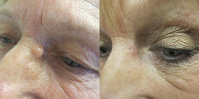 Cyst Removal Before & After Pictures - RealSelf