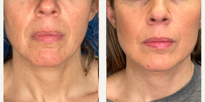 Endolift Before & After Pictures - RealSelf
