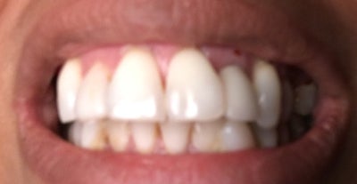 Can veneers help with large front teeth and overbite? (Photos) Doctor ...