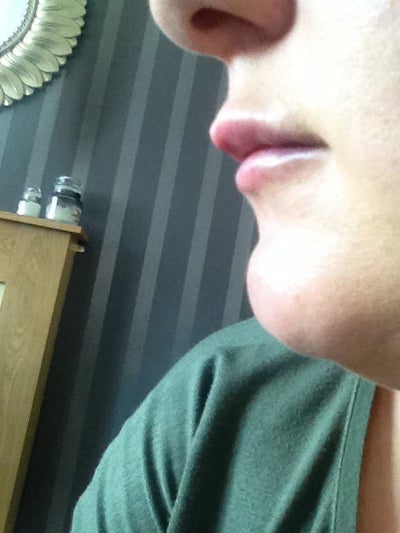 Uneven lips after Juvederm, top lip overhangs. Any suggestions? (photo ...