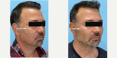 AccuTite Before & After Pictures - RealSelf