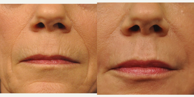 Dermabrasion Before & After Pictures - RealSelf