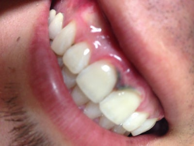 Grey and Black Gums After Professional Teeth Whitening? (photo) Doctor ...