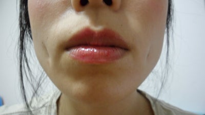Can Fillers Get Rid of Permanent Indentation from Dimpleplasty? (photo ...