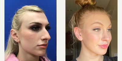 Adam's Apple Reduction Before & After Pictures - RealSelf