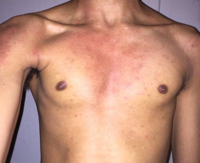 Retina burn - medijery