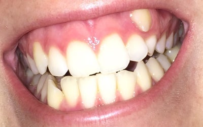 Is it possible to fix my snaggle tooth with Invisalign? Or for it to be ...