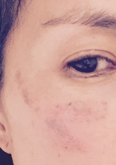Are these marks normal after IPL (crusting that should peel off) or are ...