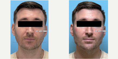 Dermal Fillers Before & After Pictures - RealSelf