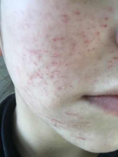 Is it normal to have scratches after microneedling? (Photo) Doctor ...