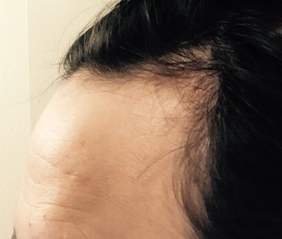 High forehead with recessed corners, looking for more feminine shape ...