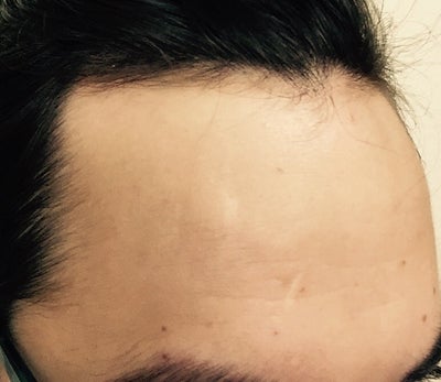 High forehead with recessed corners, looking for more feminine shape ...