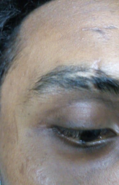 Got a cut mark on my eyebrow and lost the hairs on cut area. Suggest ...