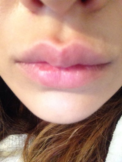 What is recommended to fix my turtle lips? (Photo) Doctor Answers, Tips