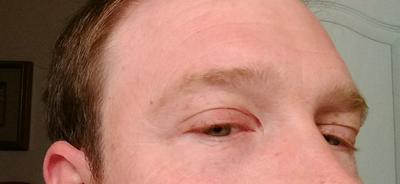 Webbing problem. What can of surgery do I need to correct it? (Photo ...