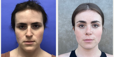 Cheek Augmentation Before & After Pictures - RealSelf
