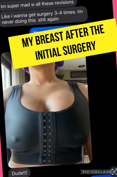 uneven breasts after augmentation