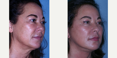 robin plastic surgery