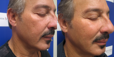 Vampire Lifting Before After