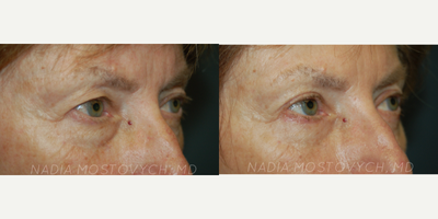 nadia plastic surgery