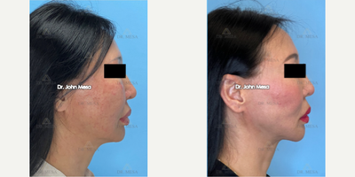 AccuTite Before & After Pictures - RealSelf