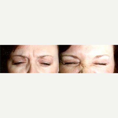 Botox Before & After Pictures - RealSelf