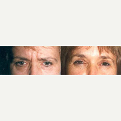 Botox Before & After Pictures - RealSelf