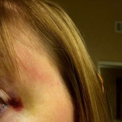 I had Botox a week ago and the bruise is still very red. How long does ...