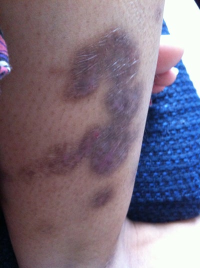 Deep dark scars due to eczema? (photo) Doctor Answers, Tips