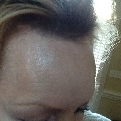 Indentations in forehead after Botox. Could it be a collapsed vein ...