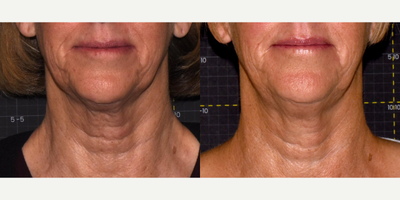 Sofwave Before & After Pictures - RealSelf