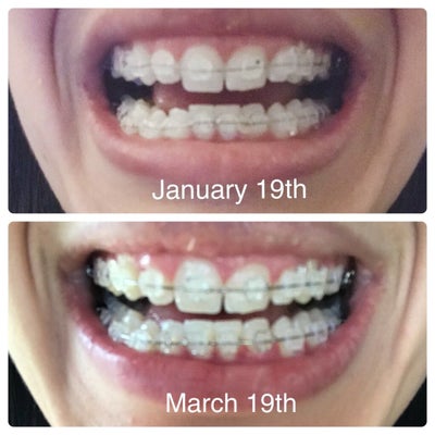 ceramic braces progress