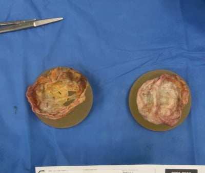 implants after 10 years