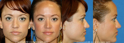 Septoplasty Before & After Pictures - RealSelf