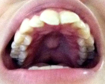 Will my big buck teeth remain too long and huge after Invisalign ...