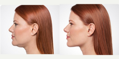 Kybella Before & After Pictures - RealSelf