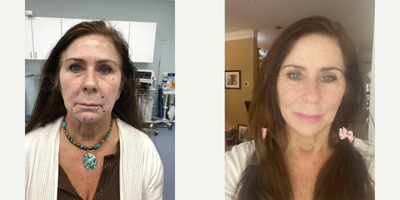 Thread Lift Before & After Pictures - RealSelf