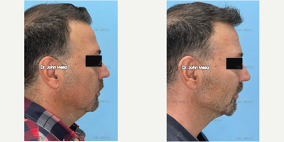 AccuTite Before & After Pictures - RealSelf