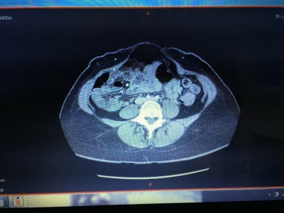 Based on these ct photos, do I have a hernia, diastasis recti or both ...