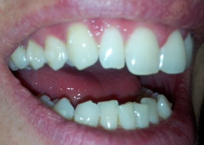 Invisalign and Black Triangles? (photo) Dentist Answers, Tips