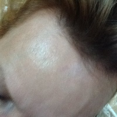 Indentations in forehead after Botox. Could it be a collapsed vein ...