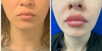 Volbella Before & After Pictures - RealSelf