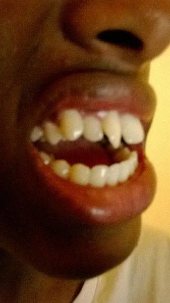 Bad teeth help? - Front buck teeth are both crooked and twisted (photos ...